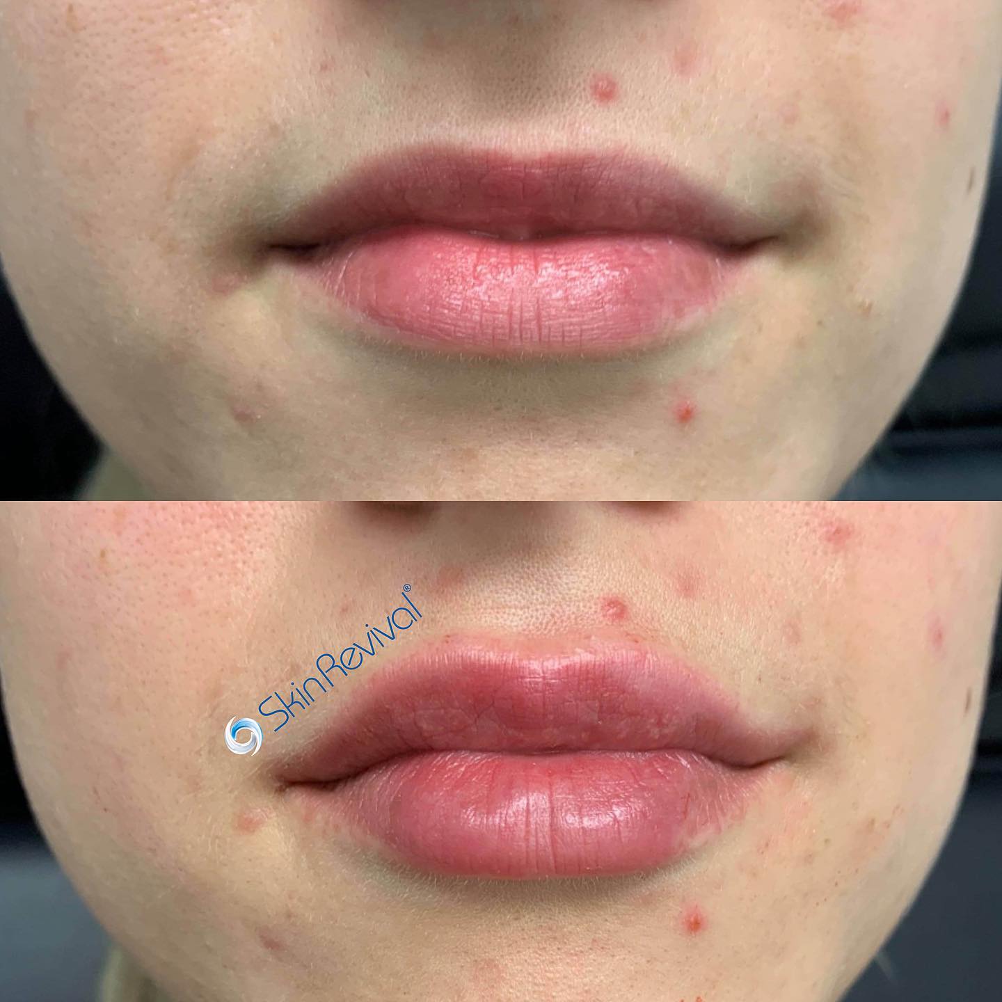 Lip Procedures – Skin Revival