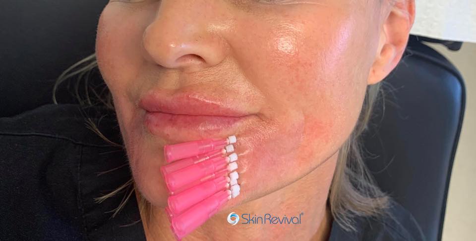 PDO Mono Threads – Skin Revival