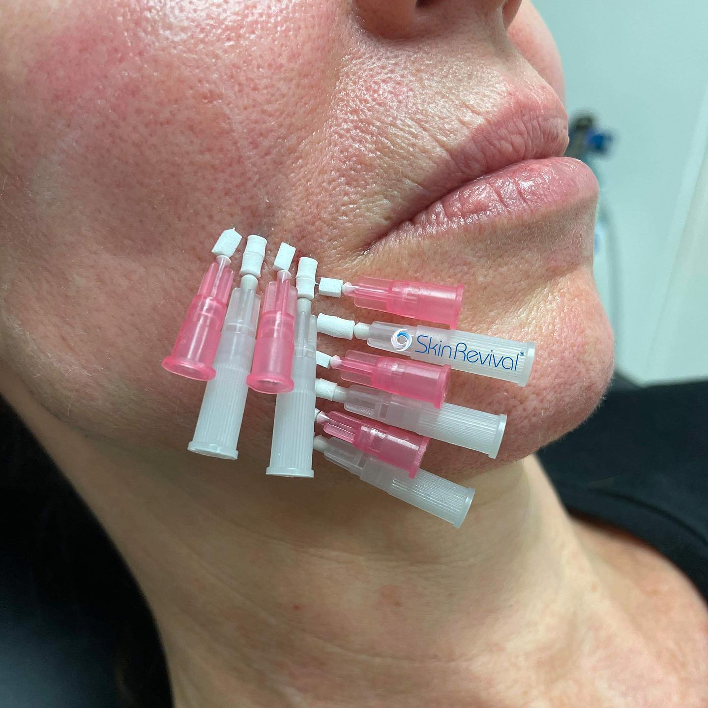 PDO Mono Threads – Skin Revival