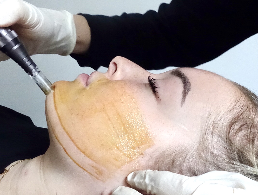 OSMOSIS PRO Nanno Pen Facial Infusion – Skin Revival Wollongong – Skin ...