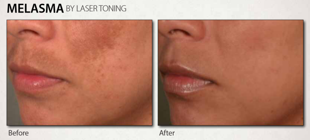 SPECTRA XT Q-SWITCH – Skin Revival Facial Wollongong – Skin Revival