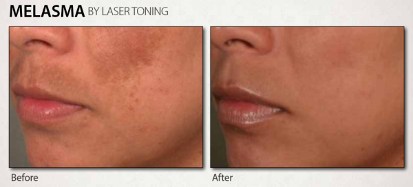 SPECTRA XT Q-SWITCH – Skin Revival