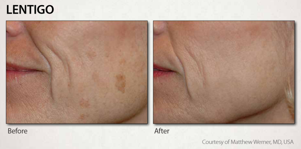 SPECTRA XT Q-SWITCH – Skin Revival