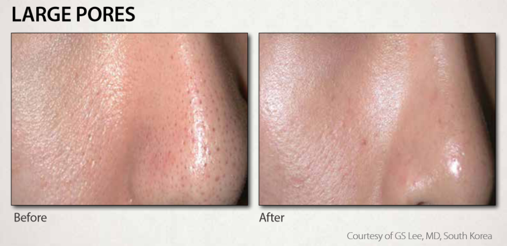 SPECTRA XT Q-SWITCH – Skin Revival