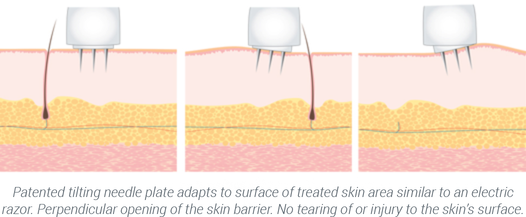 EXCEED Medical Micro Needling – Skin Revival Facial Wollongong – Skin ...